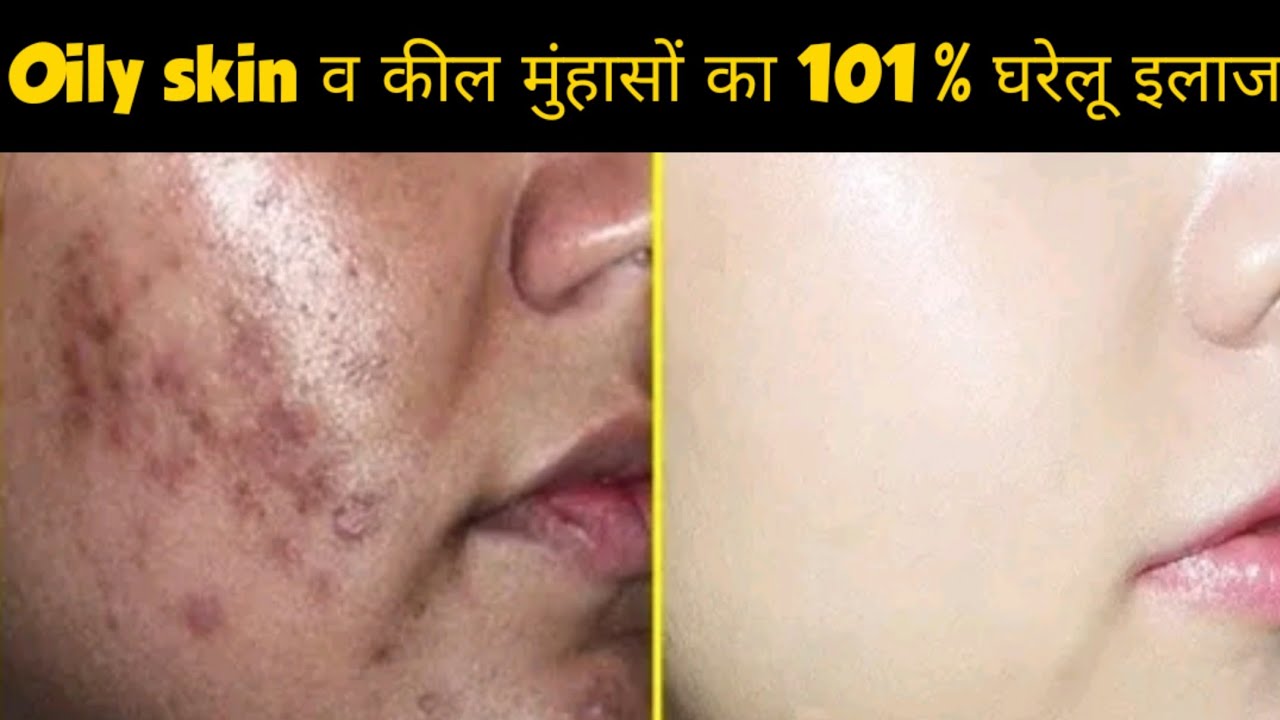 मात्र 3 दिनों में oily skin, कील मुंहासों से 101% छुटकारा / Kil muhase ...
