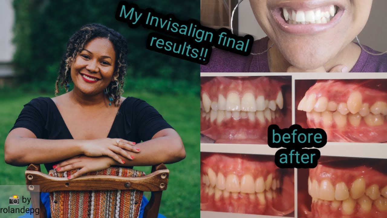 Invisalign final results | finally done 3 years later!! - YouTube