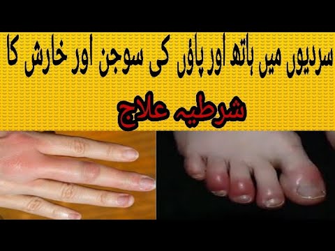 Winter Remedy | Hath Paon Ki Ungliyon Mei Kharish or Sujen Ka ilaj ...