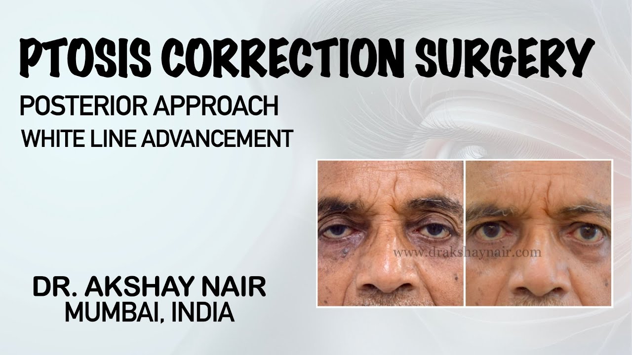 Ptosis correction: Posterior Approach - White Line Advancement: Dr ...