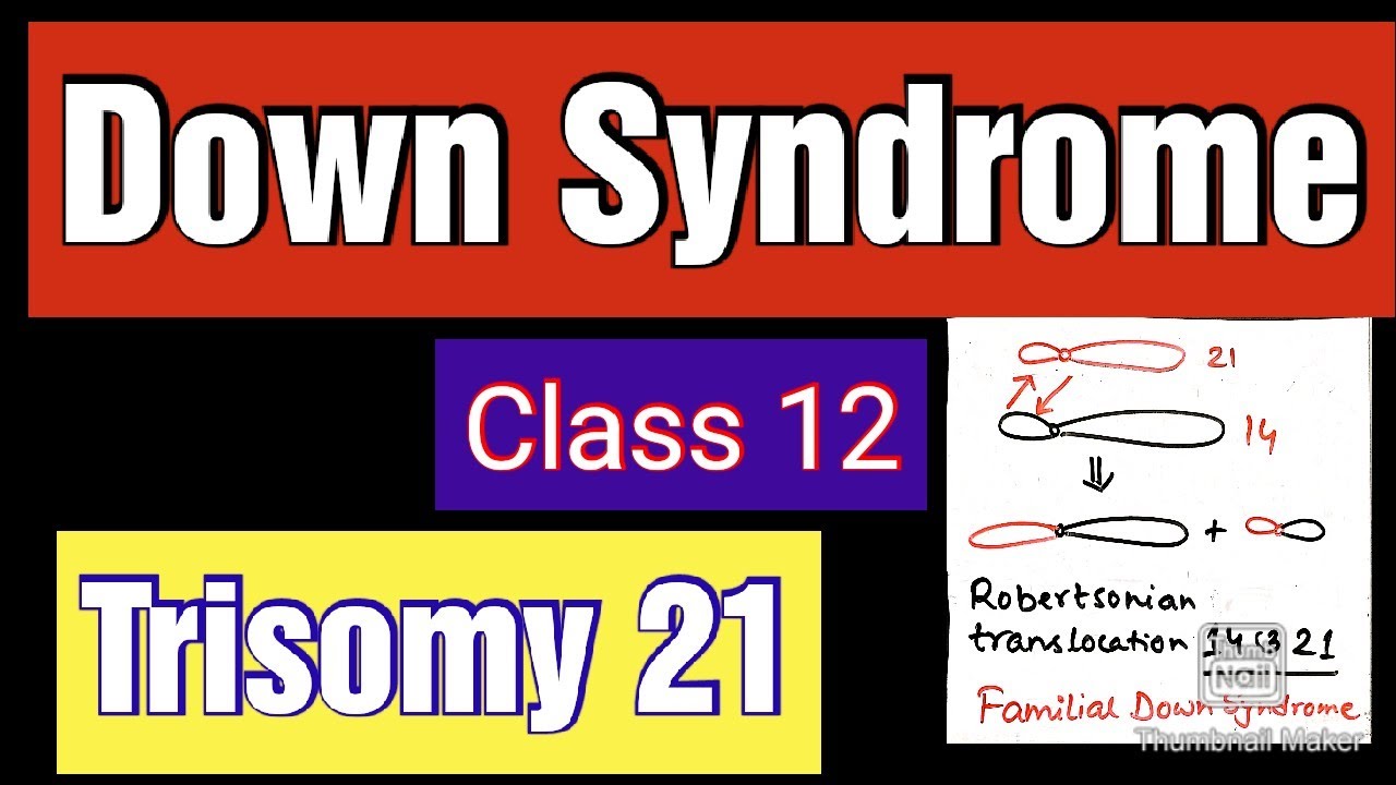 Down Syndrome in Benagli | 21 trisomy | Class 12 - YouTube
