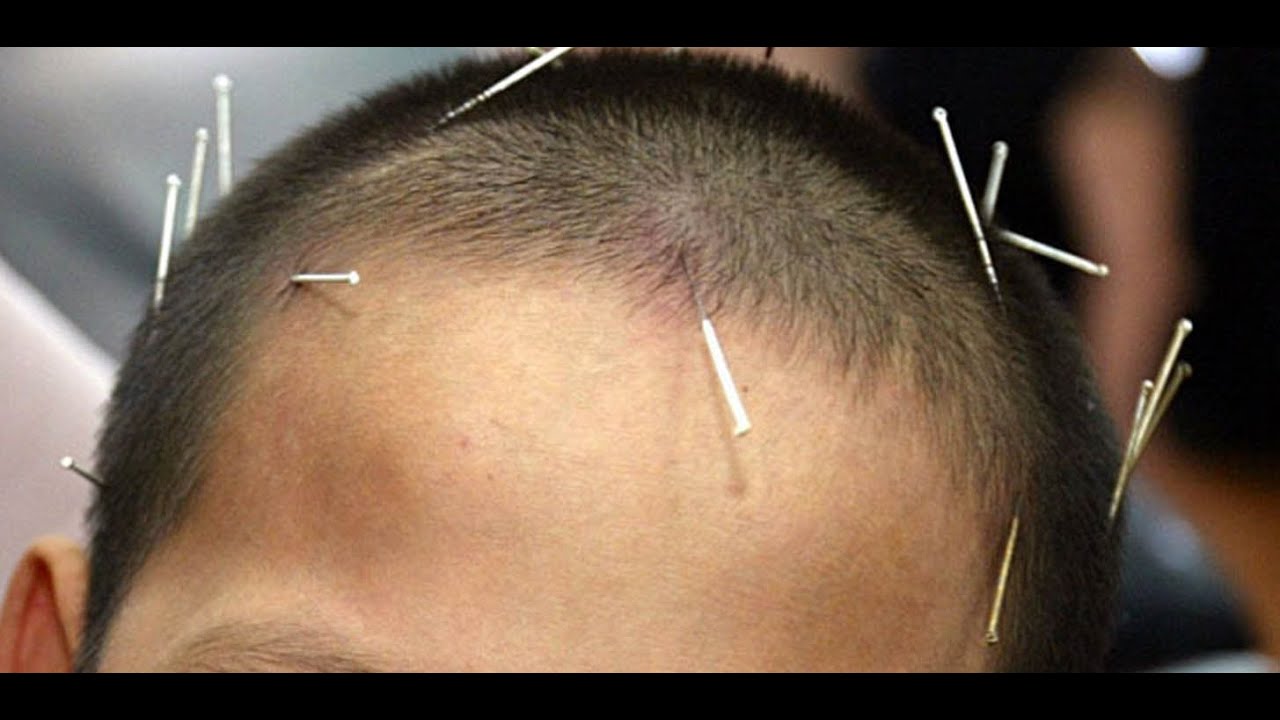 SCALP ACUPUNCTURE: Head Meridians and Points - YouTube