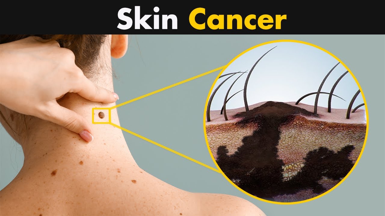 What Happens In Skin Cancer? | Symptoms, Causes and Treatment (Urdu ...