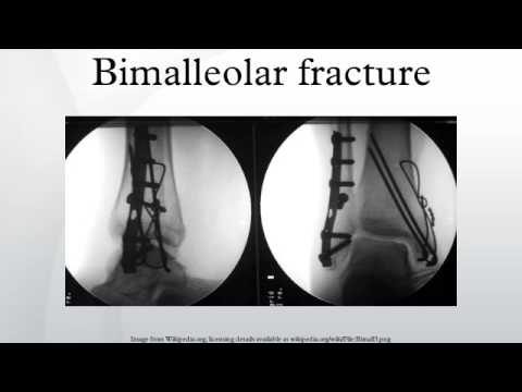 Bimalleolar fracture - YouTube