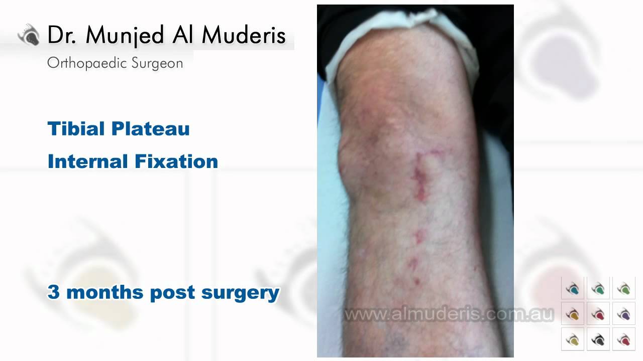 Tibial Plateau Internal Fixation - 3 months post surgery - YouTube