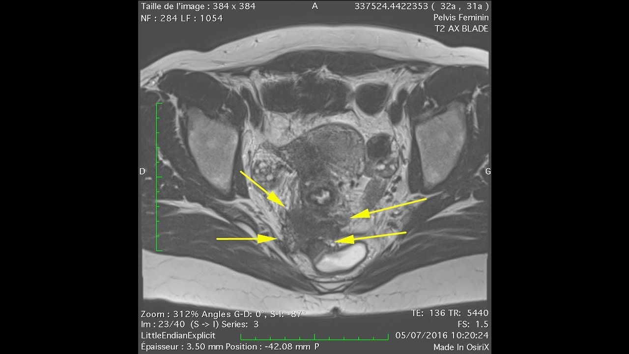 Huge endometriosis nodule of parameter, rectum, vagina, bladder and S3 ...