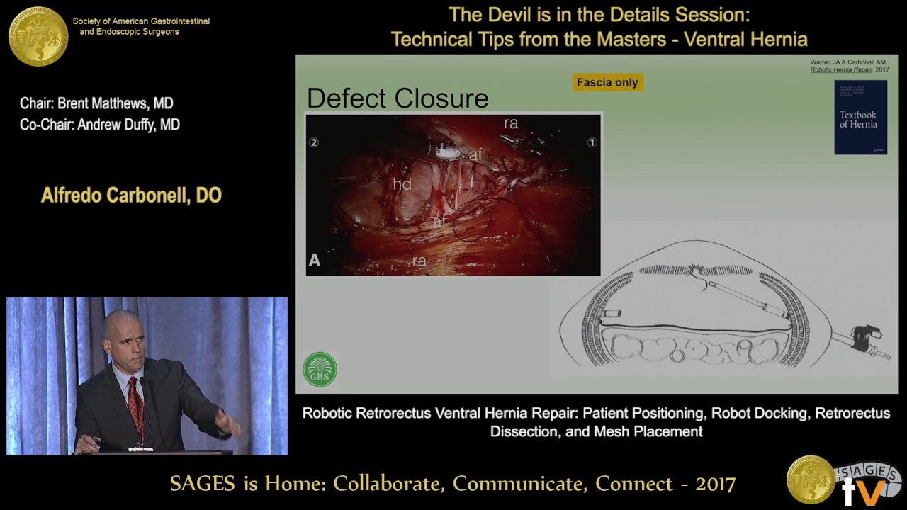 Robotic retrorectus ventral hernia repair - YouTube