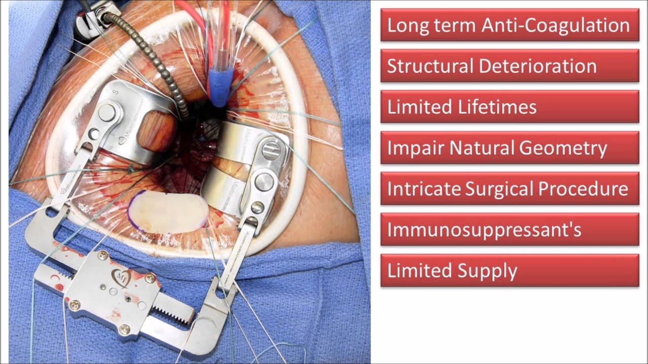 Development of a Bioengineered Decellularised Xenograft for Mitral ...