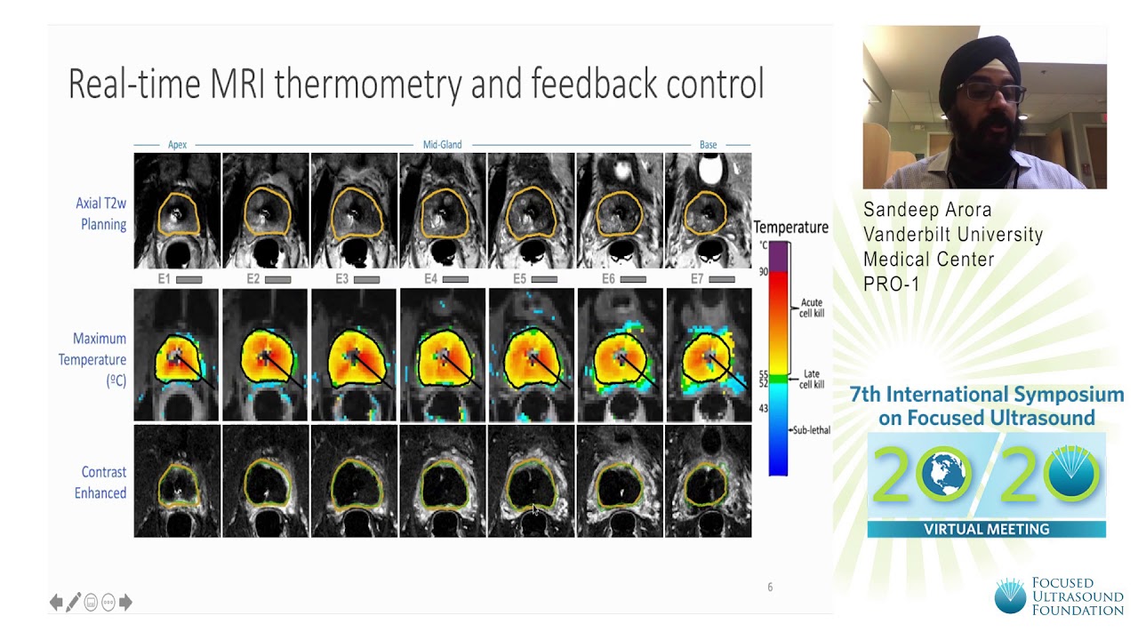 Sandeep Arora - MRI-guided Transurethral US Ablation (TULSA) in ...