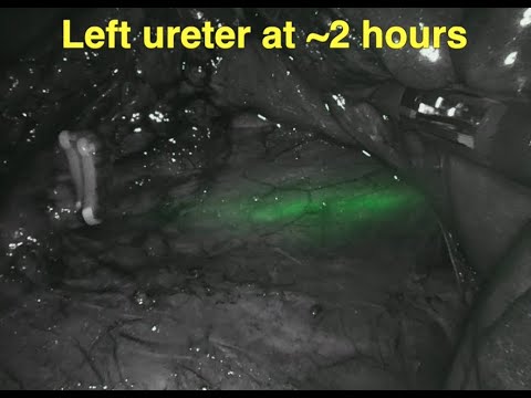 ICG Dye Technique for Ureter Identification During Robotic Colorectal ...