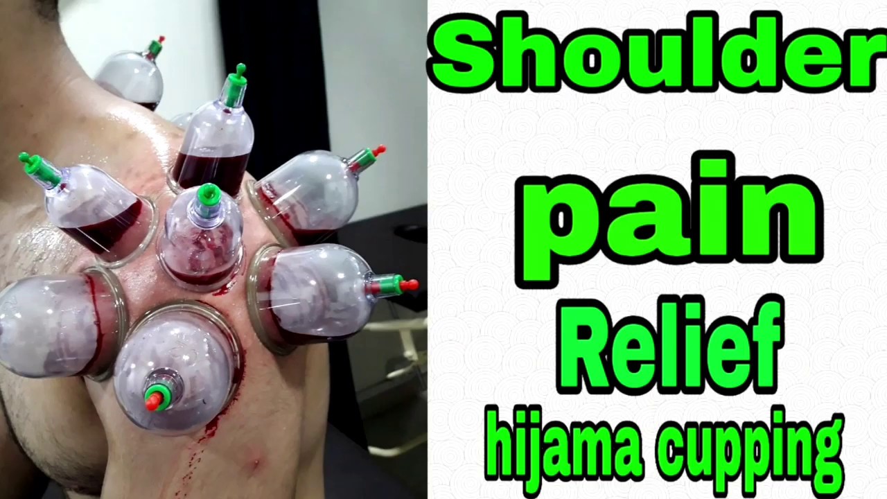Shoulder pain ( sports injury ) instant Relief post cupping / Hijama at ...