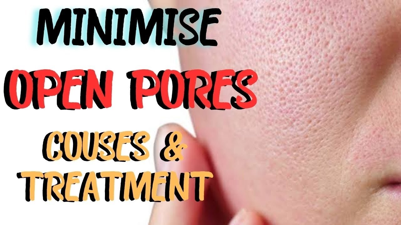 How to Minimize Open Pores? Causes & Treatments!! - YouTube
