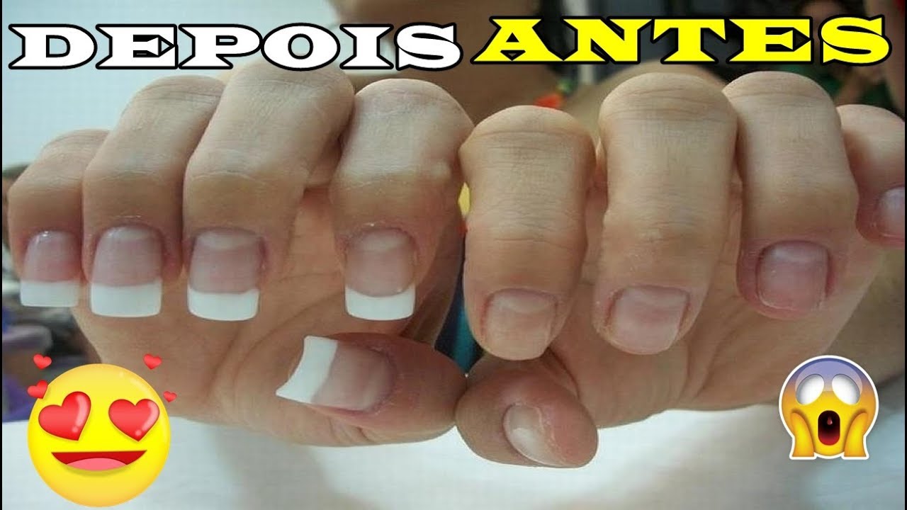 Curso De Reconstrução De Unhas Roídas - Como Reconstruir Unhas Roídas ...
