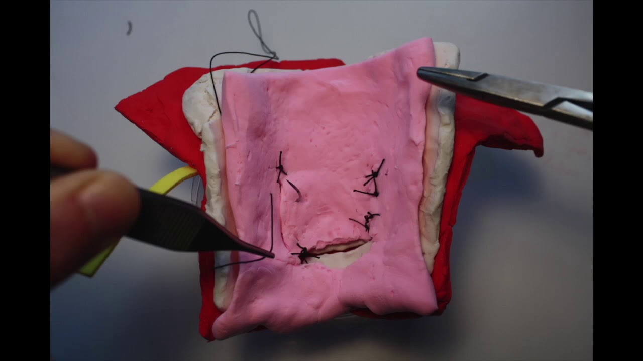 Rectal advancement flap for complex anal fistulas repair. A video ...