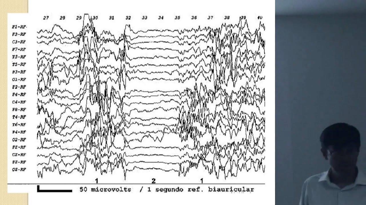 0016.EEG epilepsia I. Introdução e síndromes neonatais. OFICINAS DE EEG ...
