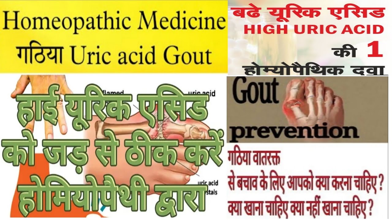 Gout Best Homoeopathic Medicine//Uric Acid or Acidicum Uricum for Uric ...
