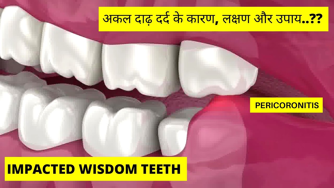अकल (अक्ल) दाढ़ दर्द के कारण,लक्षण और उपाय [ANIMATION] Impacted Wisdom ...