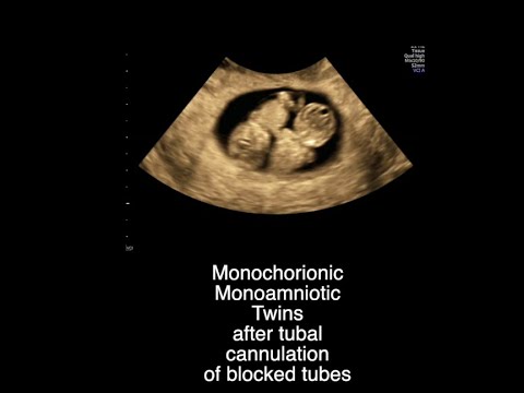 Monochorionic monoamniotic twins after tubal cannulation - YouTube