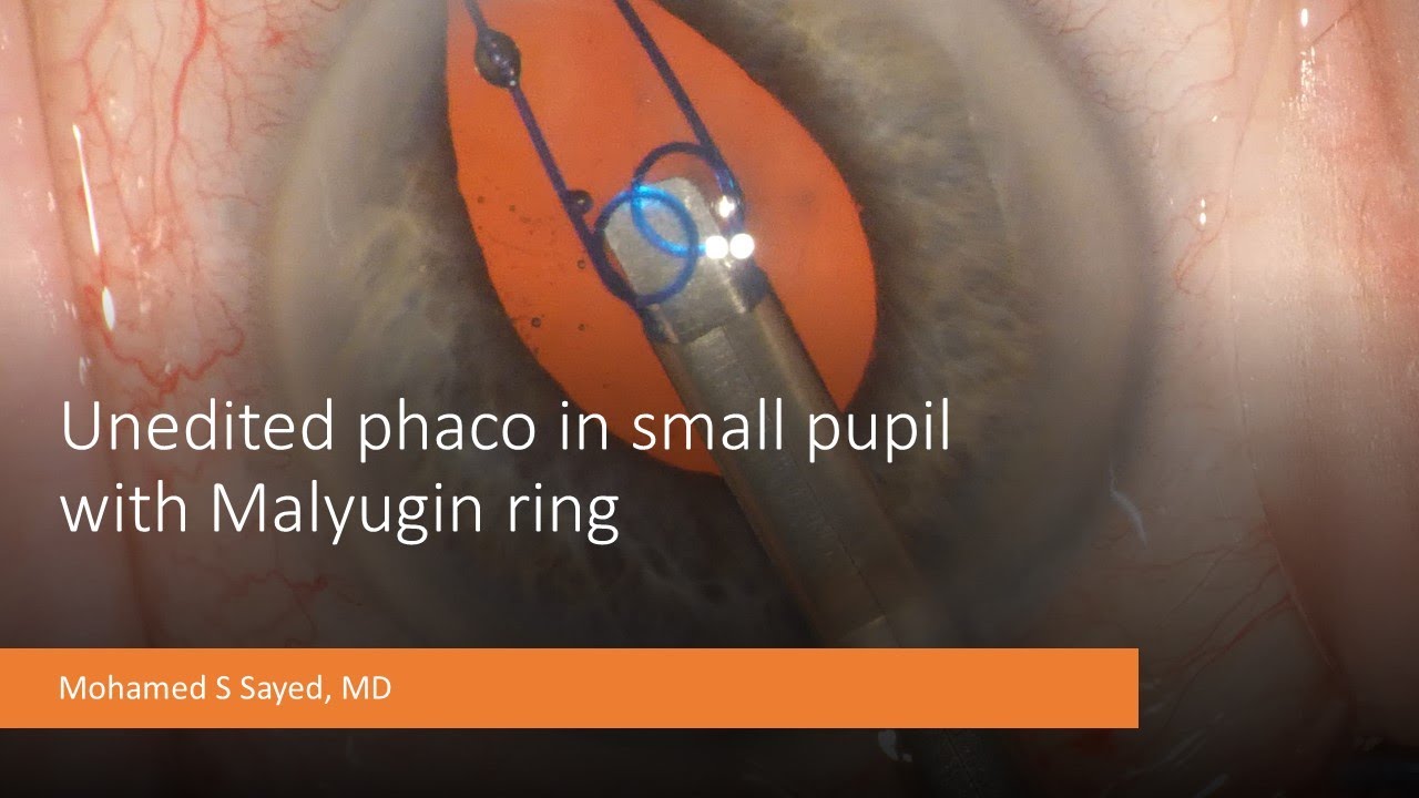 Unedited phaco in small pupil with Malyugin ring - YouTube
