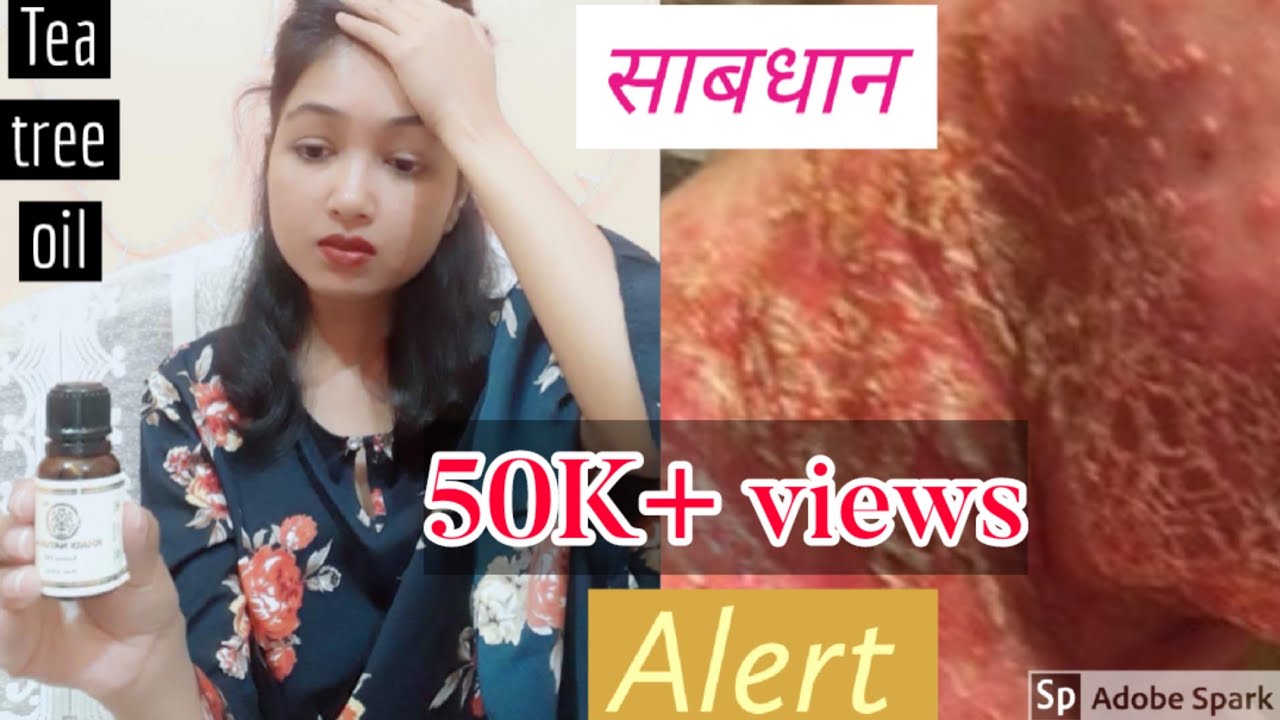 Tea Tree Oil को use करने से पहले इस वीडियो को जोरुर देख ले/ Side Effect ...