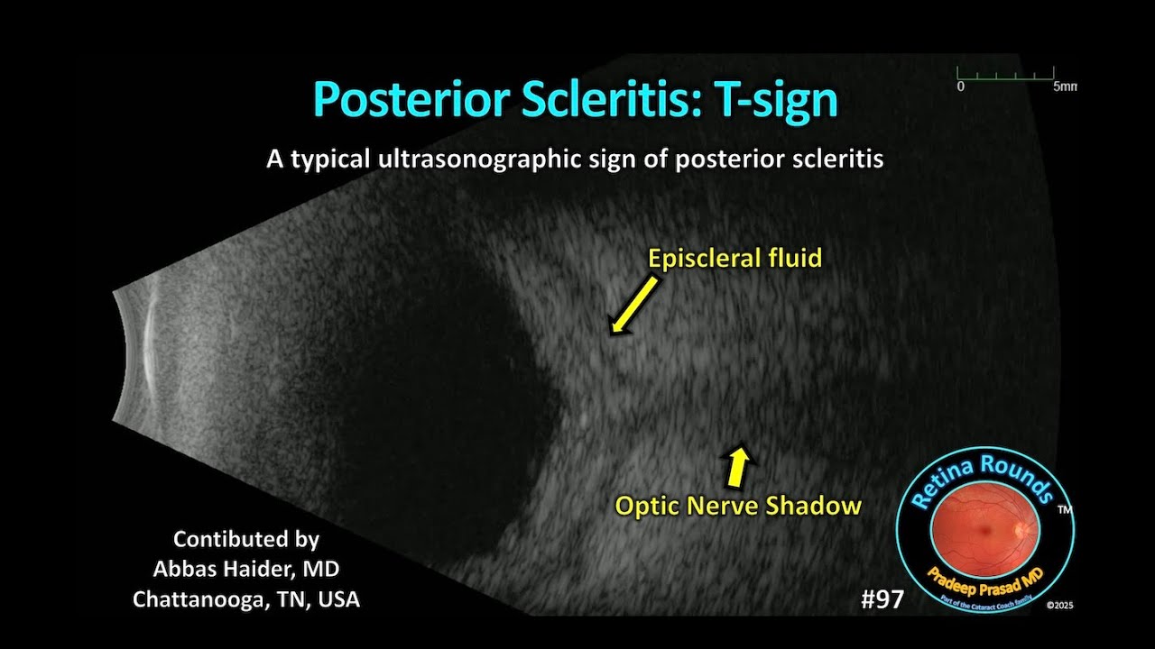 RetinaRounds™ 97: Posterior Scleritis: T-Sign - YouTube