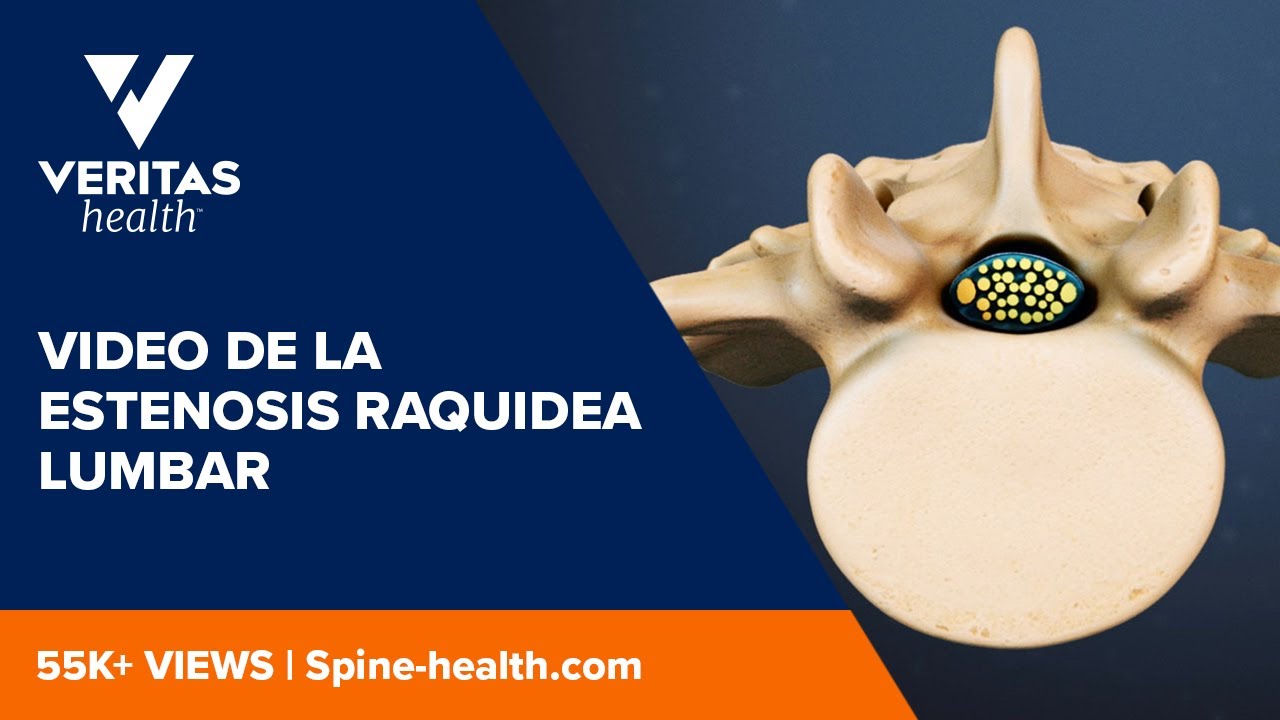 Video de la estenosis raquidea lumbar - YouTube