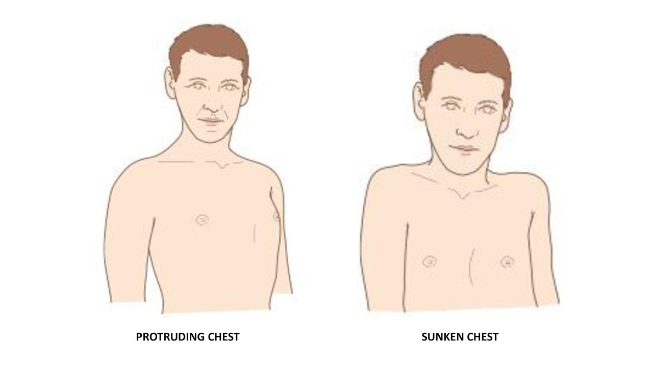 CAUSES OF PROTRUDING CHEST, SUNKEN CHEST IN TCM - YouTube