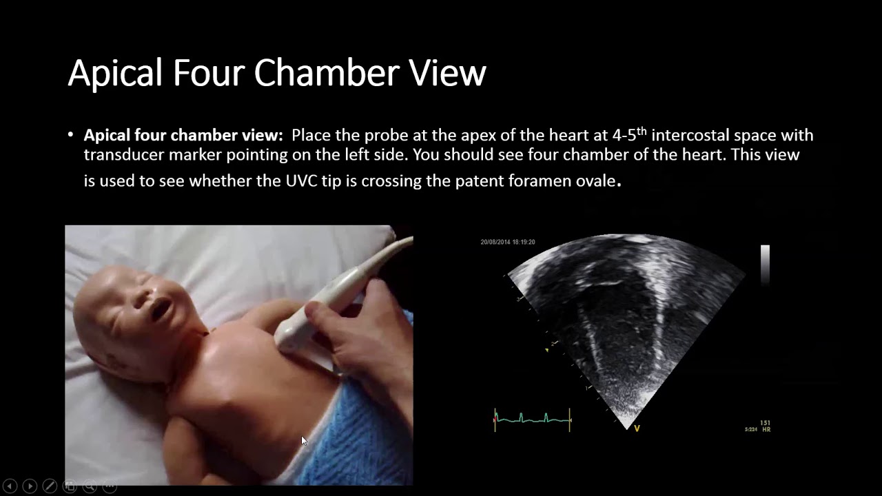 UVC assessment by Ultrasound - YouTube