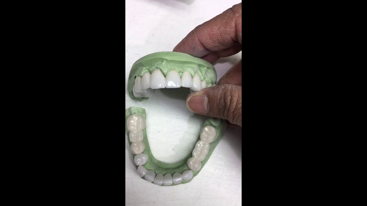 Zirconia(PFZ) and (PFM) - YouTube