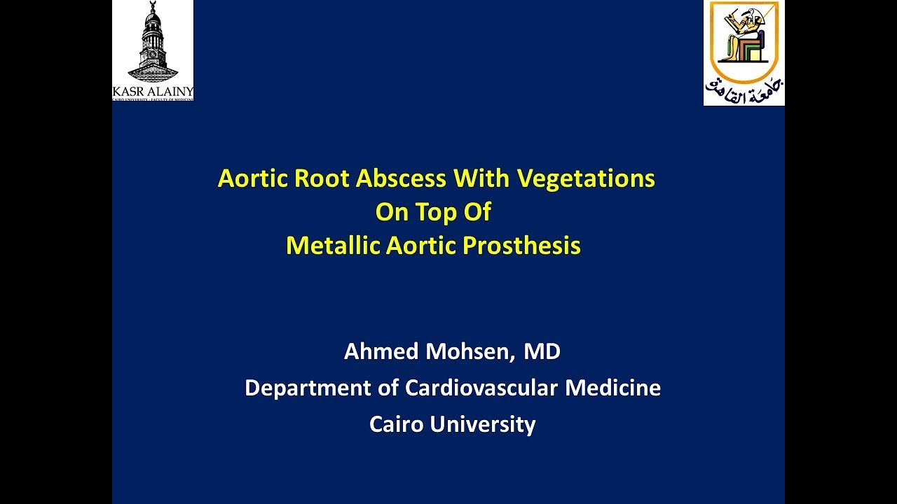 Aortic root abscess with vegetations on top of metallic aortic ...
