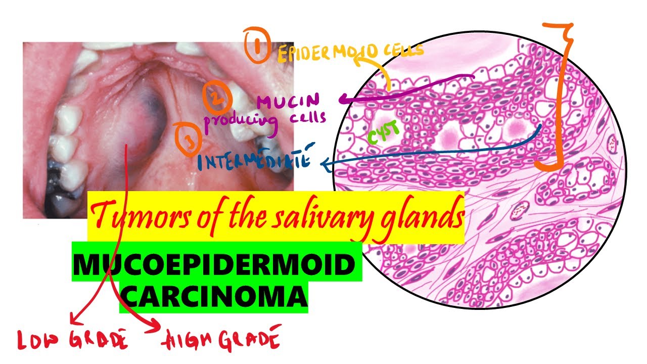 Mucoepidermoid carcinoma Histopathology | Clinical features | DETAILED ...