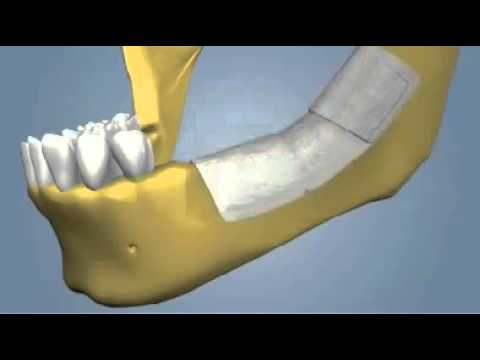 Implante dental con injerto de hueso en bloque autólogo posterior - YouTube