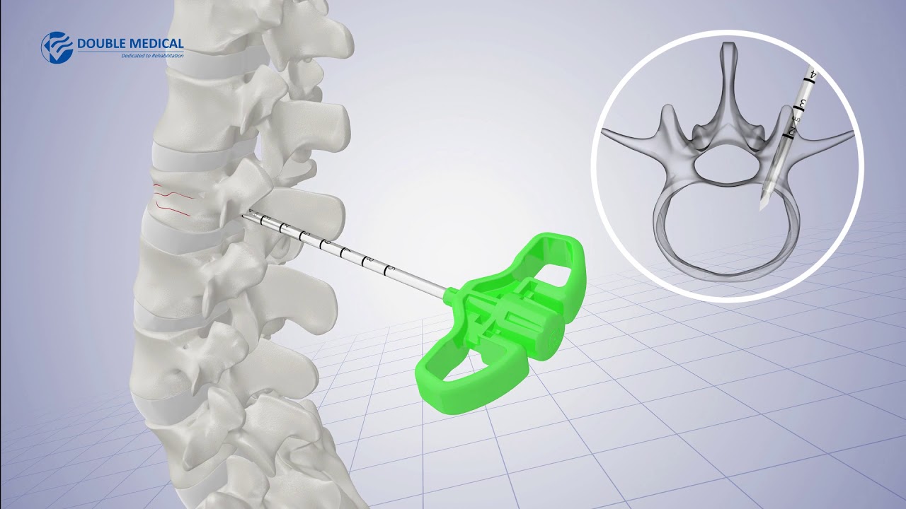 Double Medical Percutaneous Vertebroplasty System - YouTube