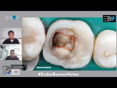 Manejo de Conductos Calcificados PARTE II - YouTube