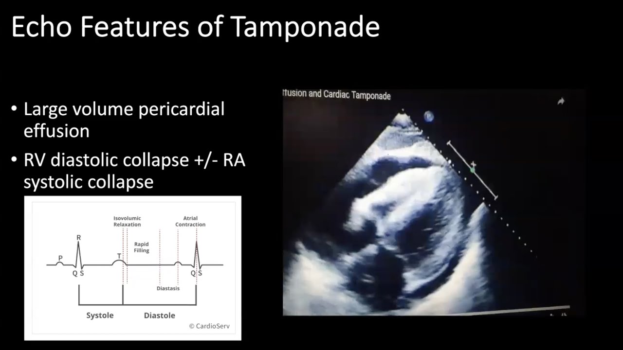 Lecture tamponade Pocus collaborative Dec 2021 - YouTube