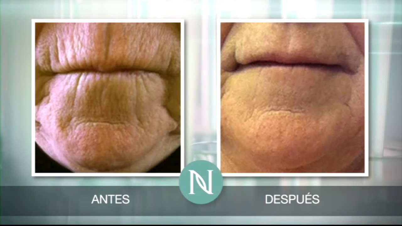 Antes y Después de Neora. Resultados Reales en personas Reales - YouTube