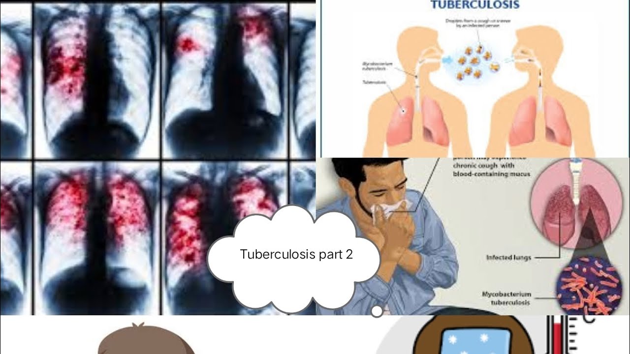 Tuberculosis part 2 |Treatment| identify| symptoms #medical #students # ...