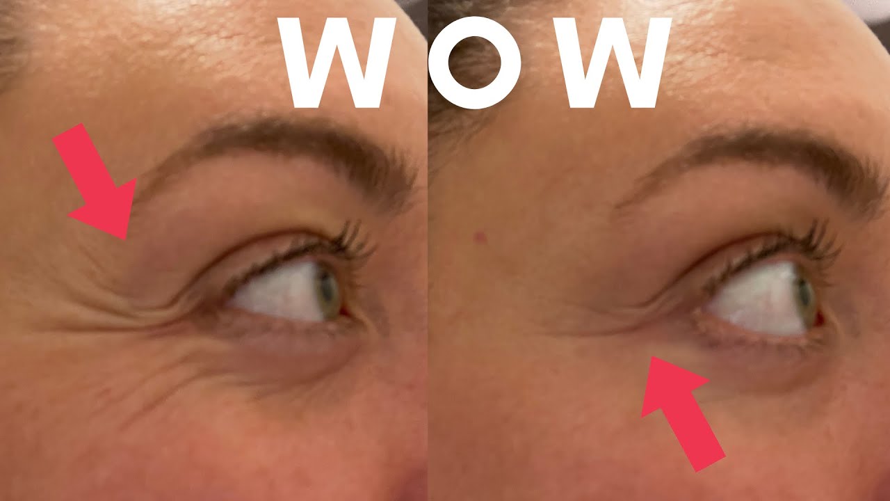 Best facial exercises for Crows feet| Face yoga| wider eyes| wrinkle ...