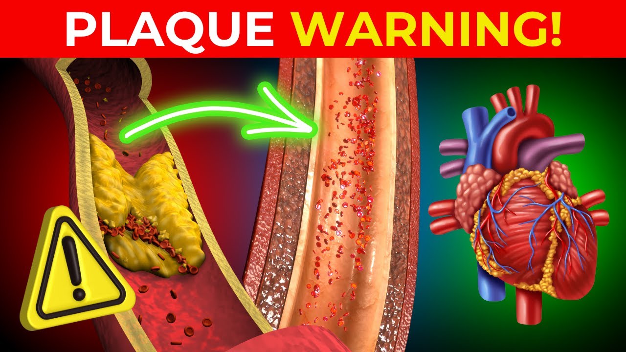 SILENT Artery Killer? Remove DEADLY Plaque & Save Your Heart Naturally ...