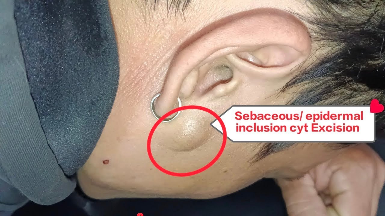 Sebaceous (Epidermal inclusion) cyst Excision in Preauricular Region | Step-by-Step Procedure ...
