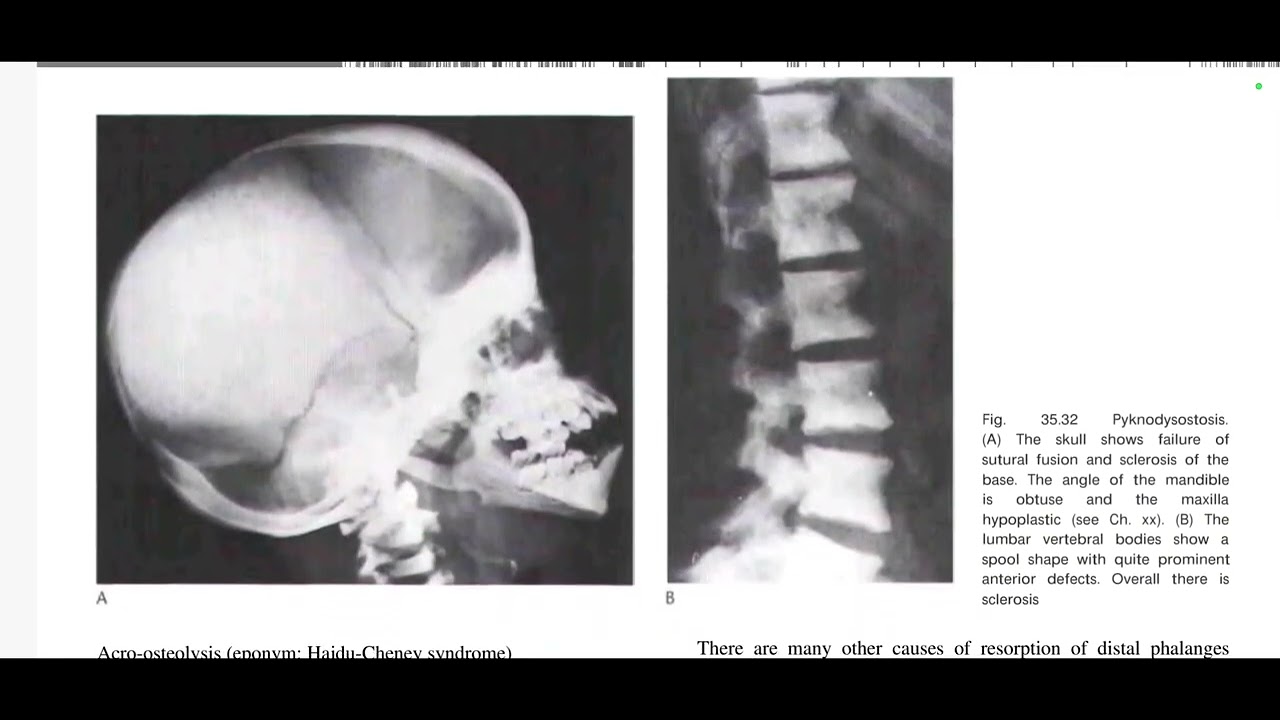 MSK SUTTON VOL 2 TEXTBOOK OF RADIOLOGY(1) - YouTube