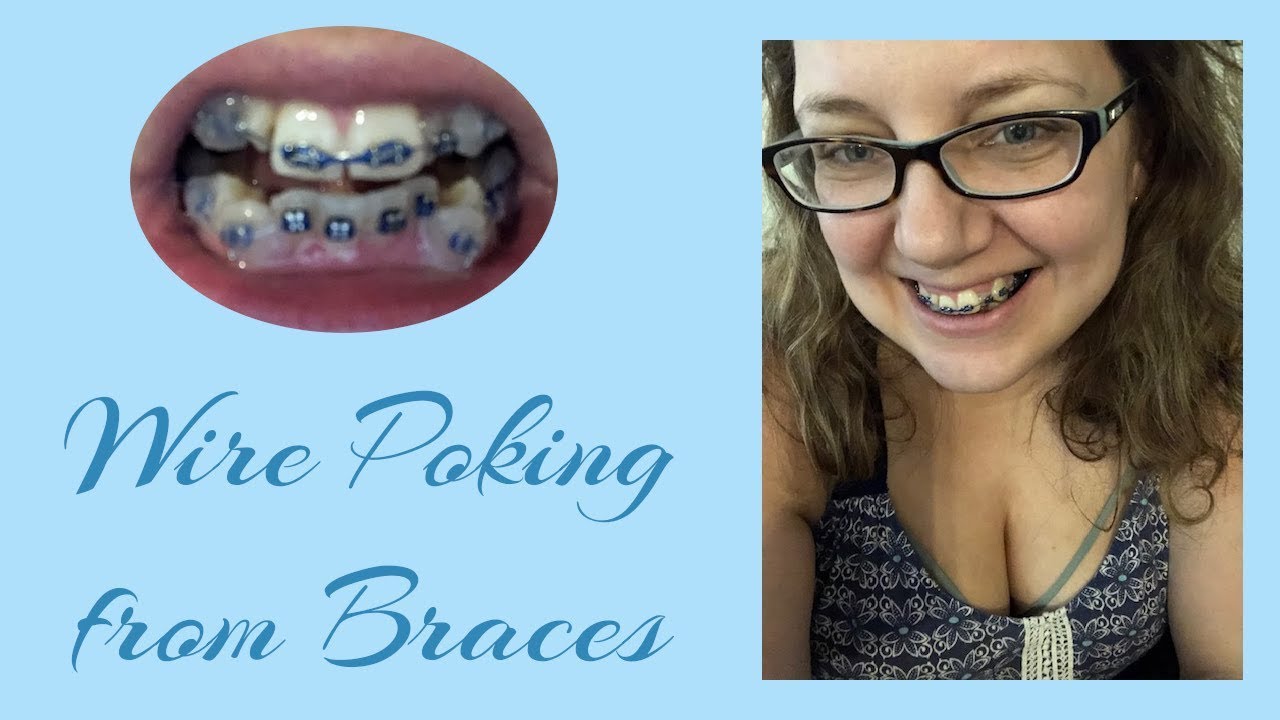 WIRE POKES MY GUMS! - YouTube