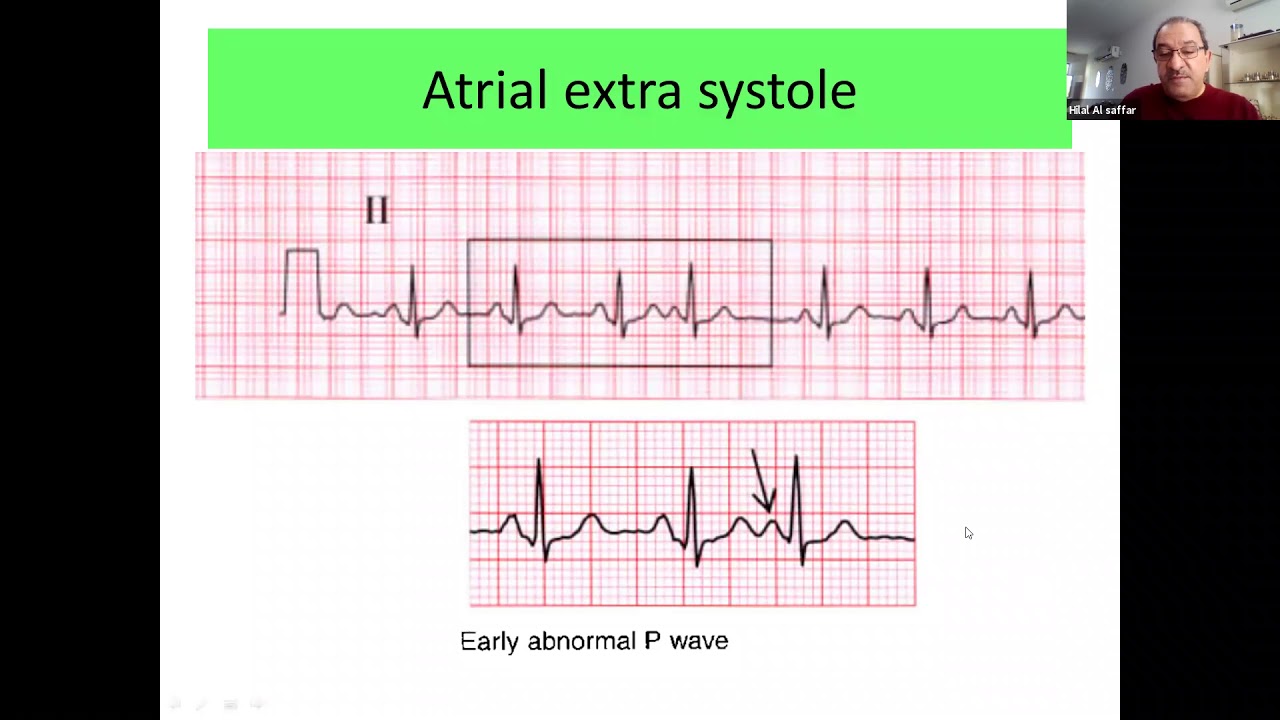 ECG normal variant and ECG in systemic disease - YouTube