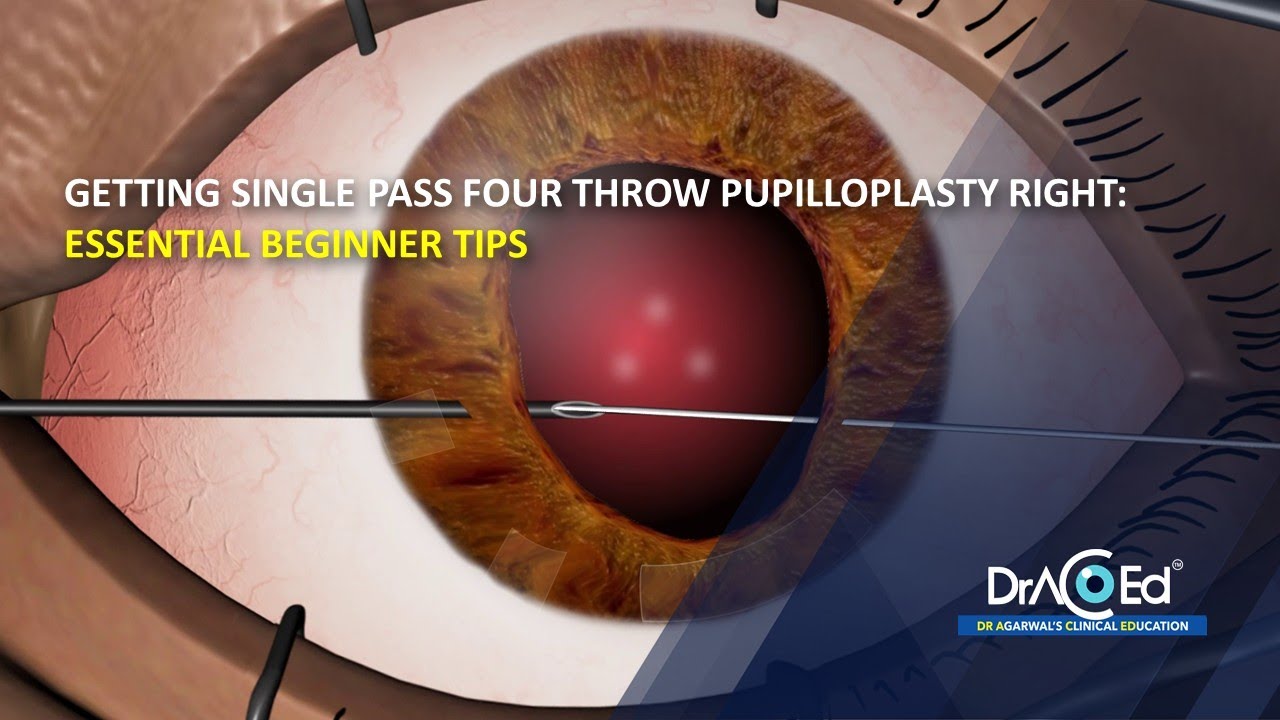 42 | Getting Single Pass Four Throw Pupilloplasty Right: Essential ...