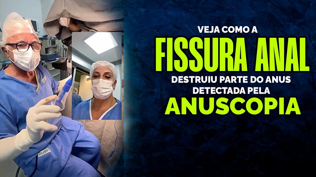 Veja como fissura anal destruiu parte anus detectada pela anuscopia ...