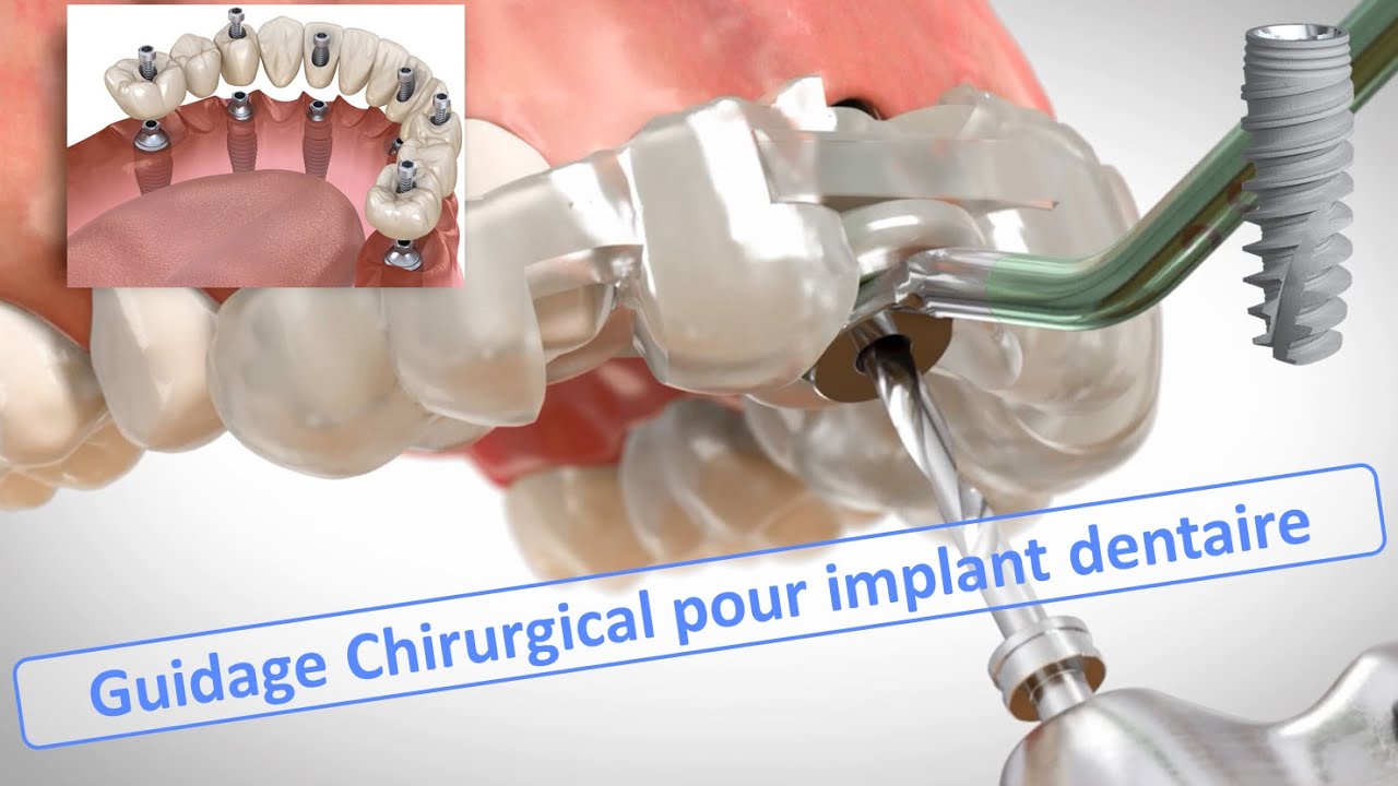 All-on-4 : Guidage Chirurgical numérique pour implant dentaire - YouTube