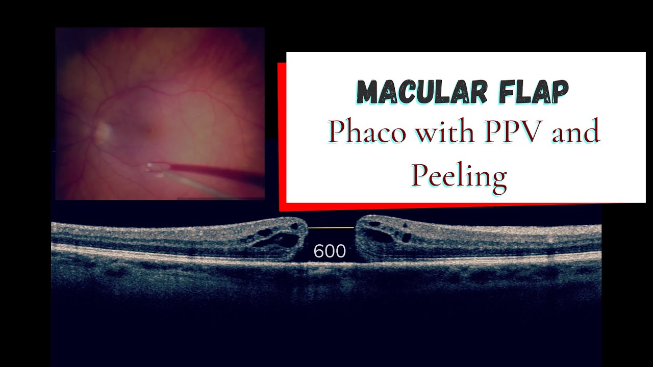 Macular flap in myopic eye /result at the end - YouTube