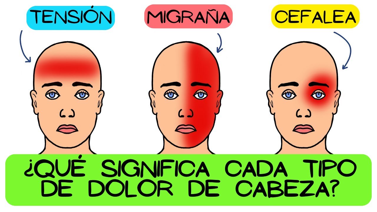 ¿CÓMO saber mi tipo de DOLOR DE CABEZA según la zona y qué significa ...
