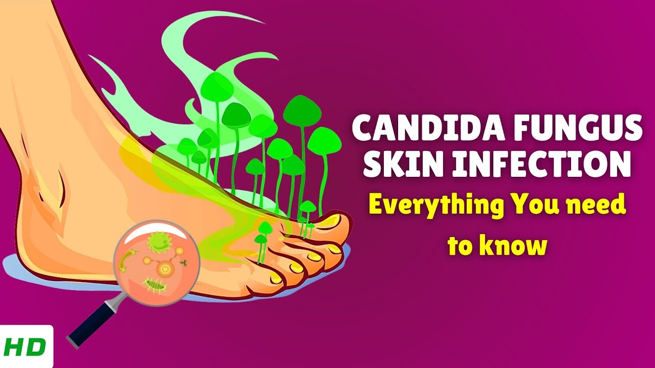 Candida Fungus Skin Infection – Causes, Signs and Symptoms & Effective ...