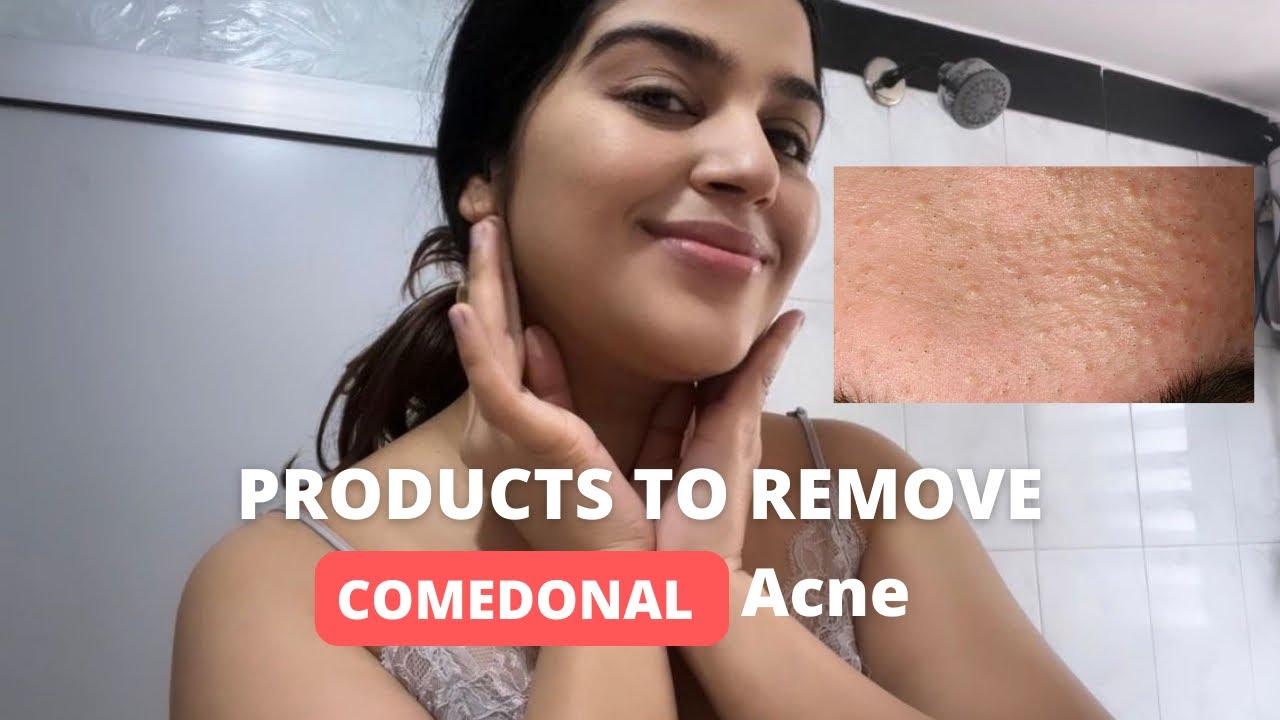 Products to remove Comedonal Acne | Skincare products to remove ...